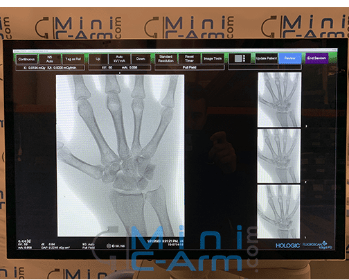 Hologic InSight FD Mini C-Arm for Sale, Lease or Rent | Mini C-Arm.com